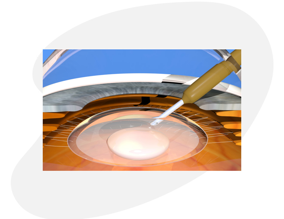 Refractive Lens Exchange · Laser Eye Institute
