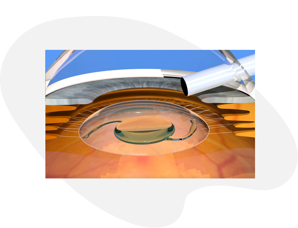 Refractive Lens Exchange · Laser Eye Institute