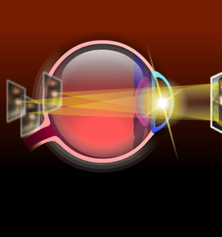 What Is Keratoconus? · Laser Eye Institute